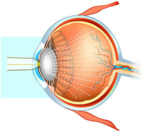 Learn More About Cataracts : Eye Group of Connecticut