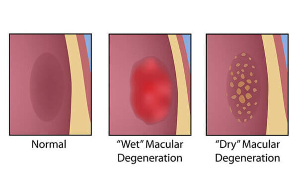 Macular Degeneration : Eye Group of Connecticut